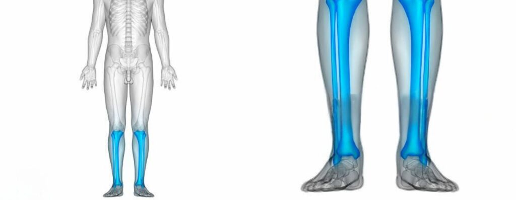 Distal Fibula Bone Fractures: Causes, Treatments, and Advanced ...